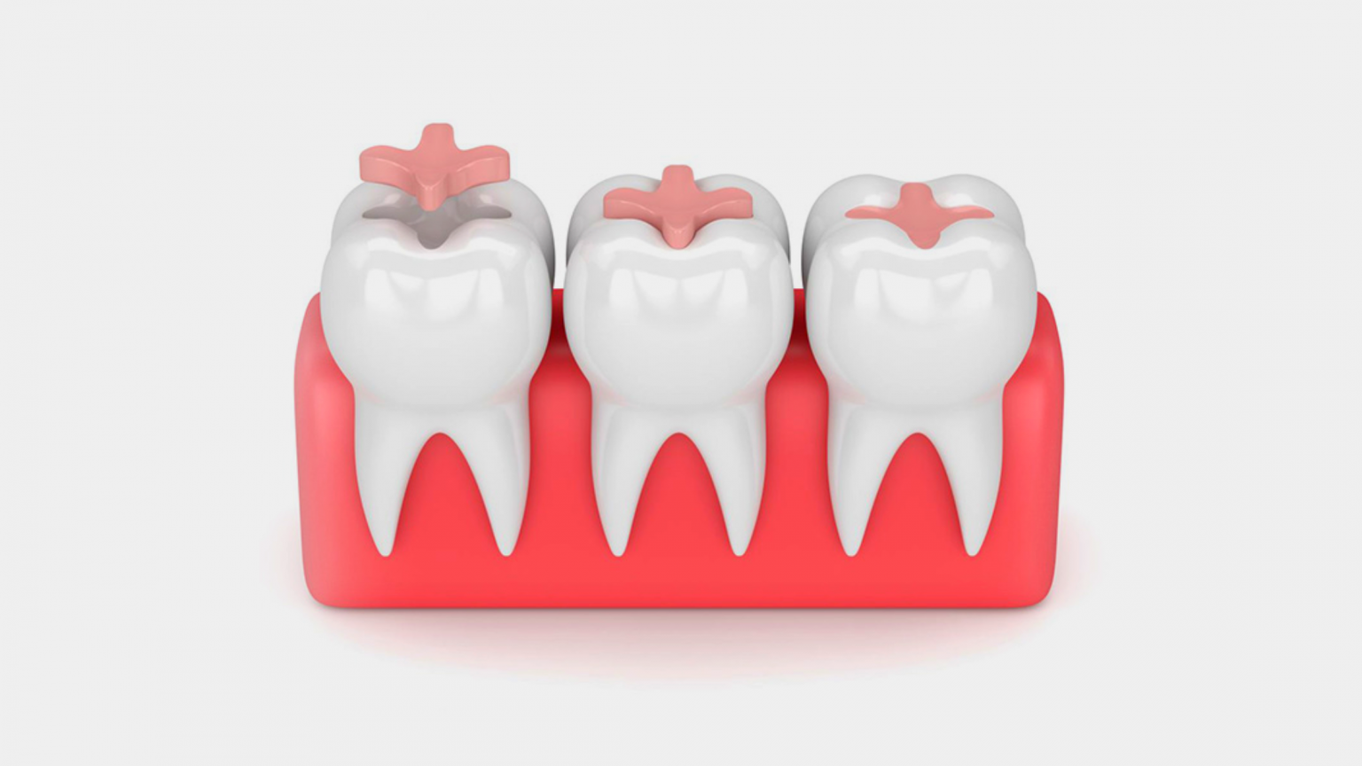 Types of Dental Fillings: All You Need to Know